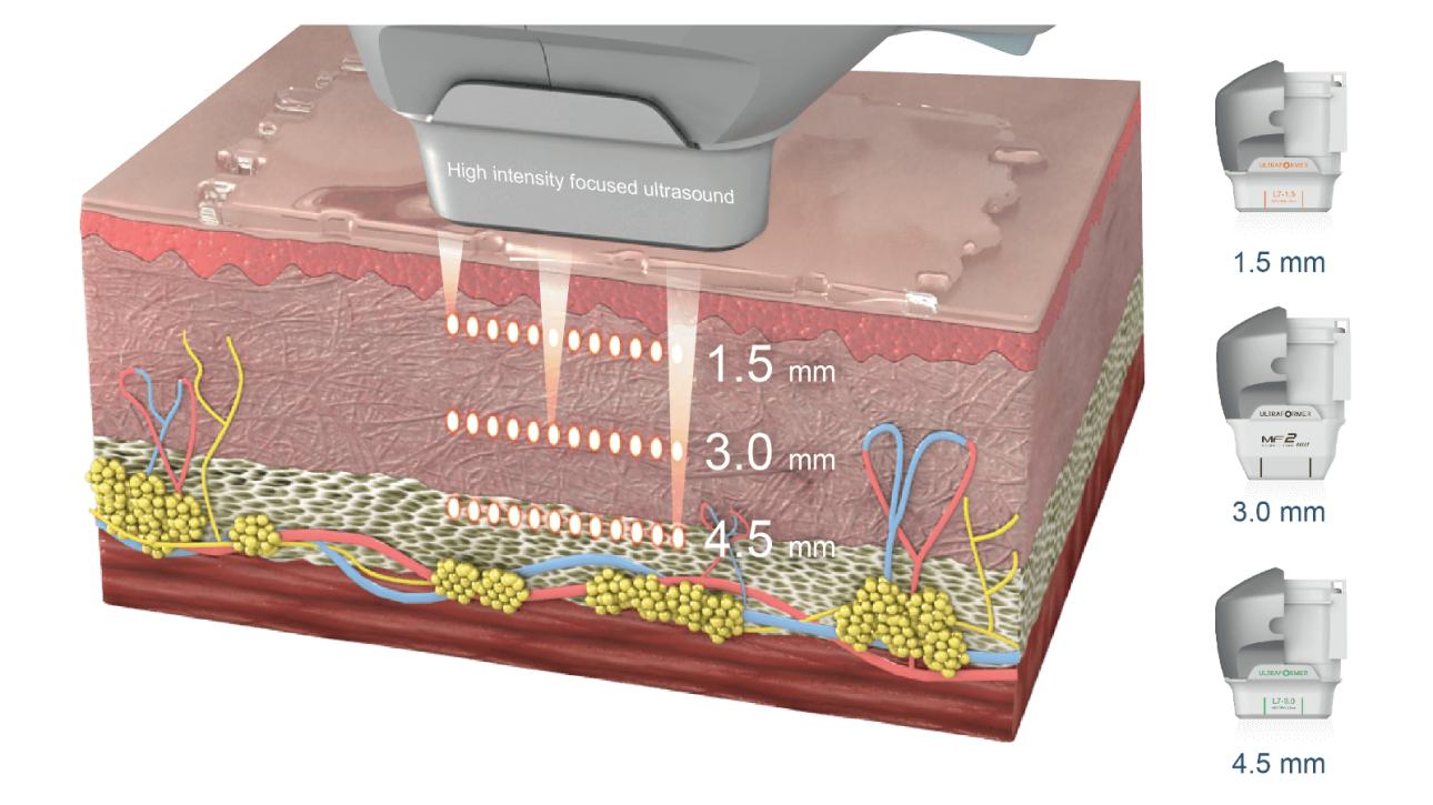 All about Ultherapy Prime | Non Invasive Face lift and tighten