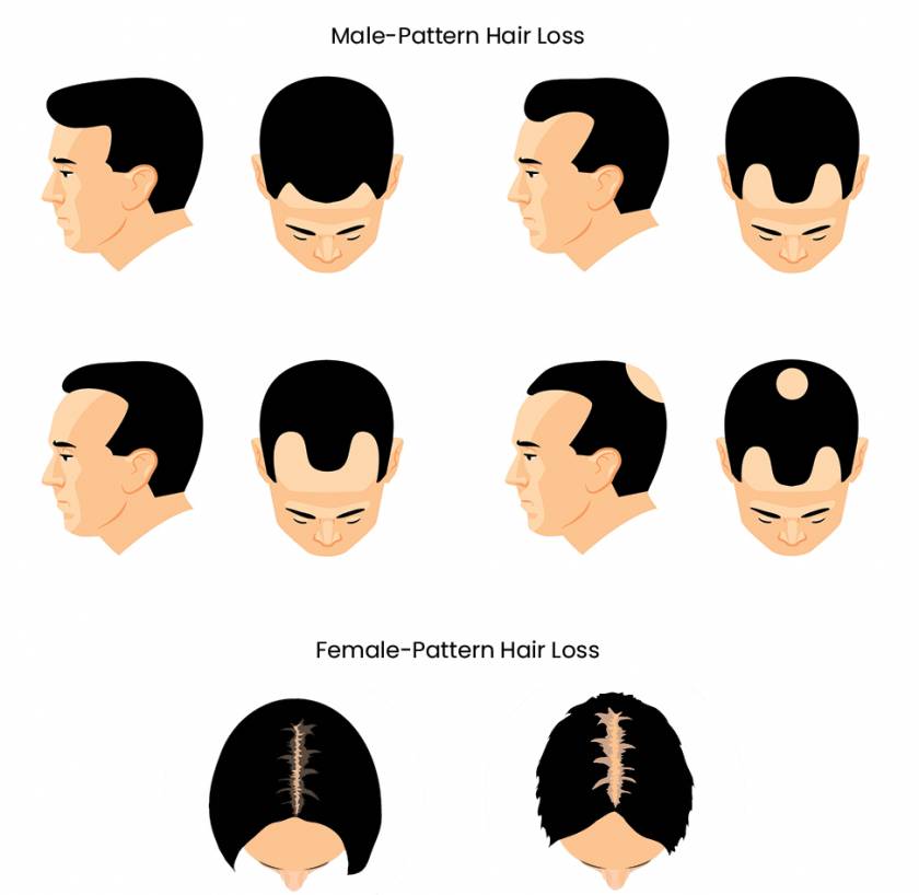 All about Regen Hair Therapy in Singapore | Stimulate Hair Growth