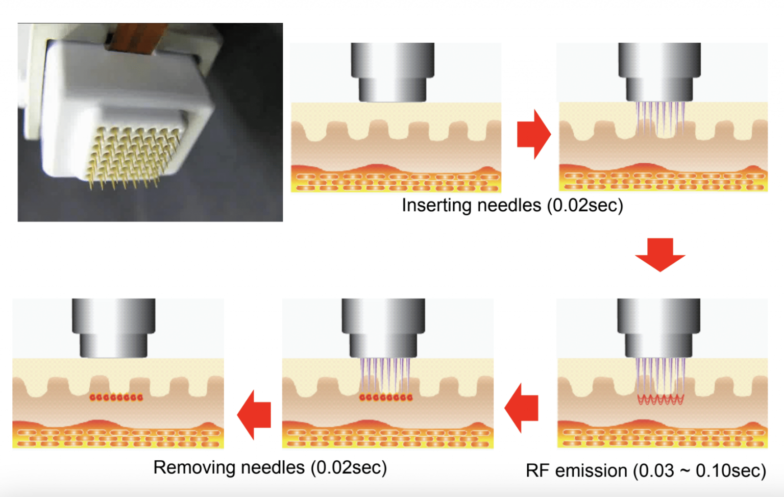 All About Fractional Micro-needling RF | Scars, Wrinkles, Pores