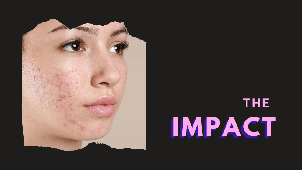 The Maskne Pandemic – Acne Outbreak - Ageless Medical
