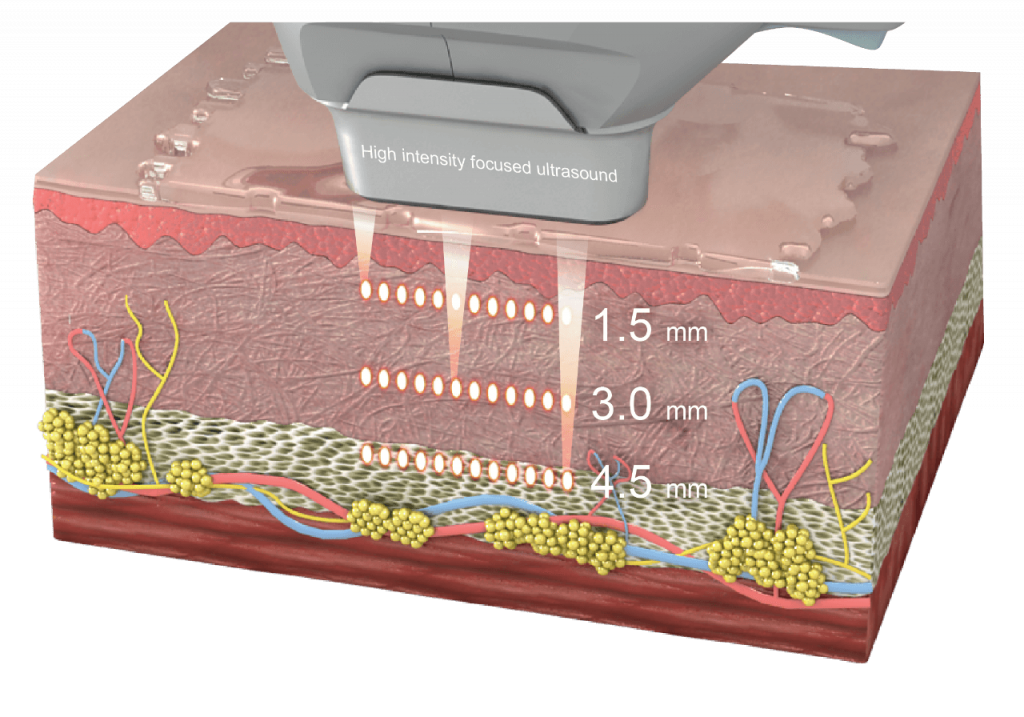Non-Surgical Skin Tightening Techniques – All you need to know ...