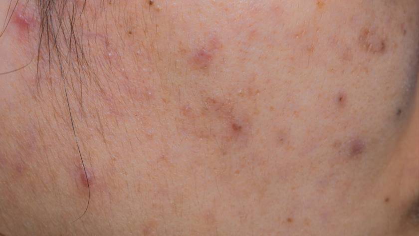 Pigmentation: Causes and Types - Ageless Medical