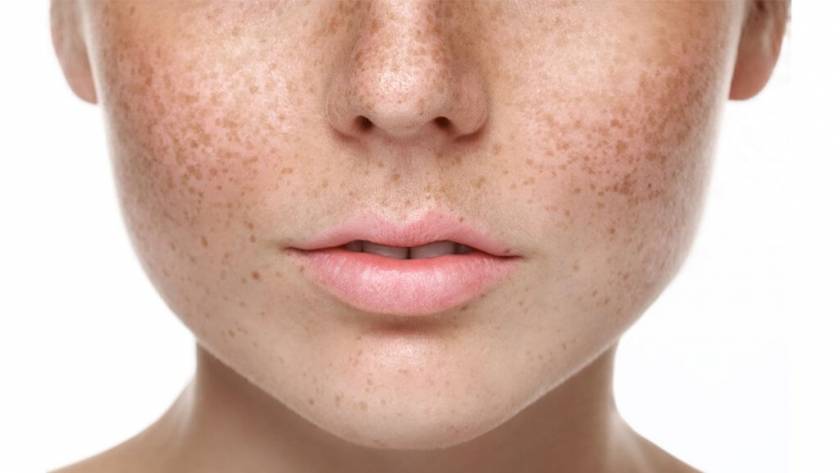Pigmentation: Causes and Types - Ageless Medical
