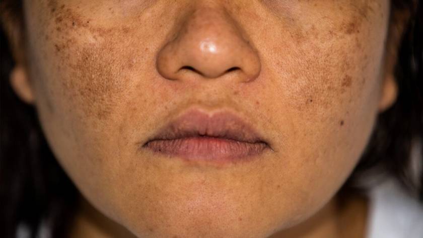 Pigmentation: Causes and Types - Ageless Medical